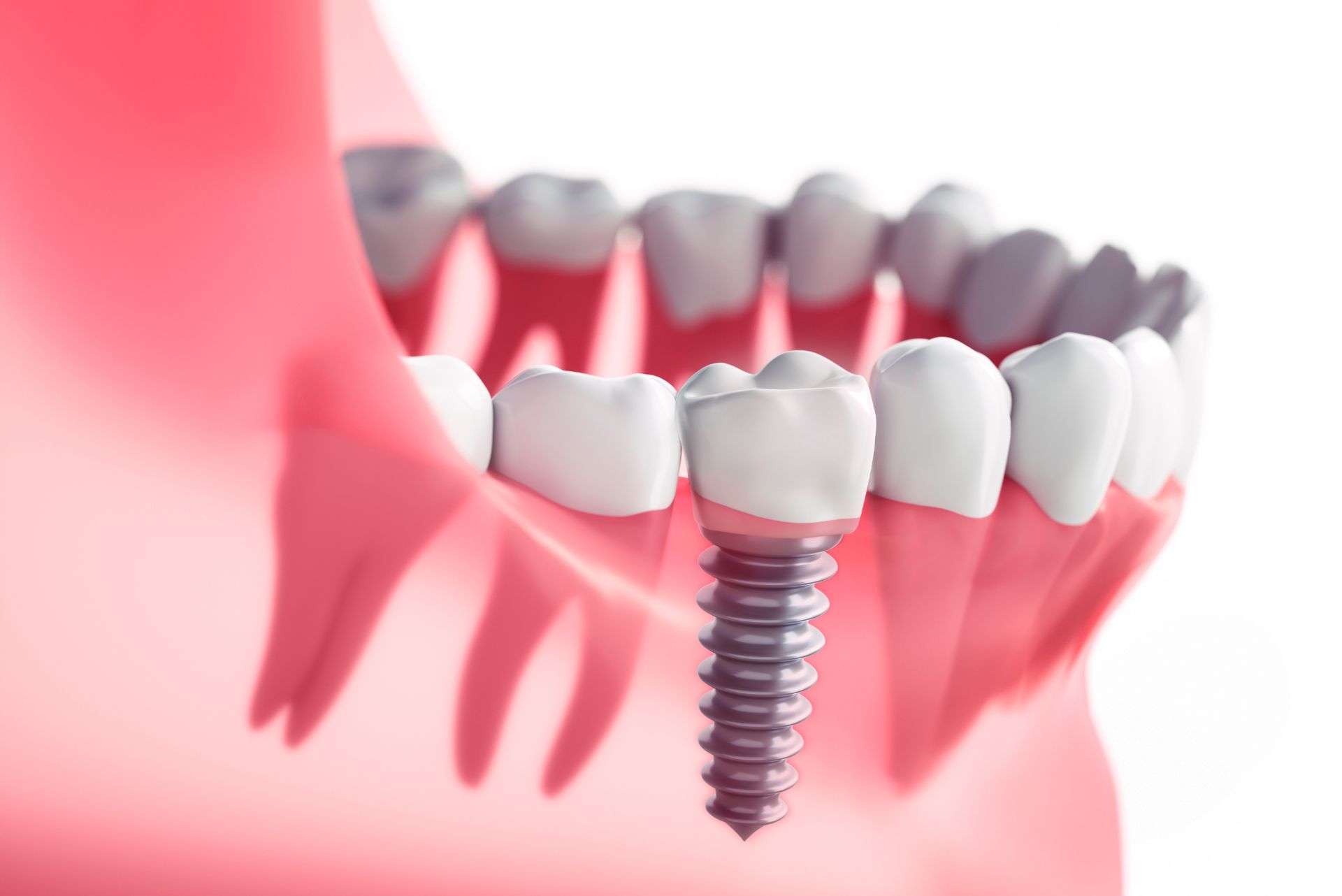 Implantes Dentales - clinicadentalonesmile